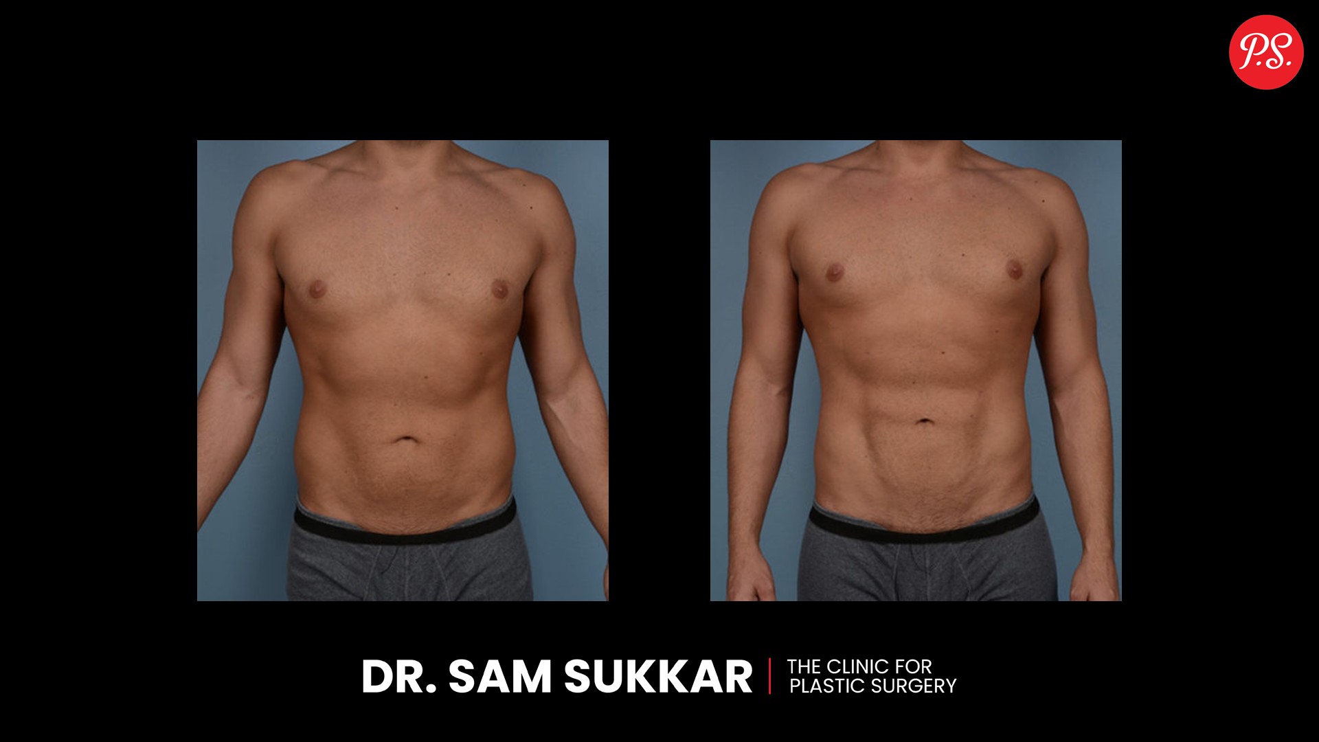 Ab Etching Before & After Pictures With Results | Houston Plastic ...